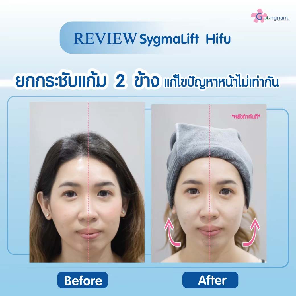 Sygmalift Hifu ยกกระชับ ปรับรูปหน้า เห็นผลทันทีหลังทำ พิเศษเฉพาะกังนัม ...