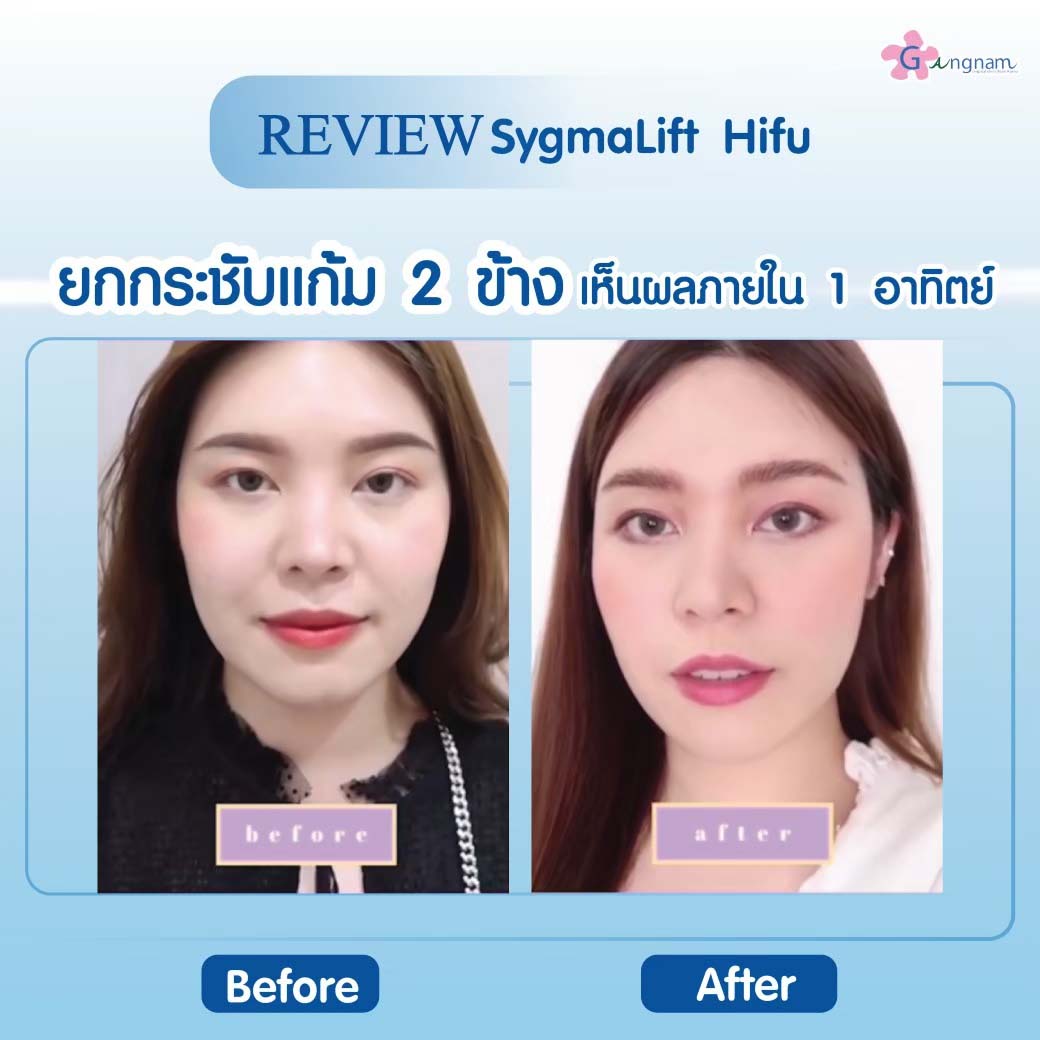 Sygmalift Hifu ยกกระชับ ปรับรูปหน้า เห็นผลทันทีหลังทำ พิเศษเฉพาะกังนัม ...