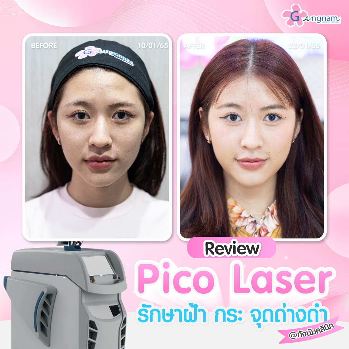 Pico Laser คืออะไร? รวมข้อมูลครบ ข้อดี ข้อเสีย และการดูแลหลังทำ - กัง ...