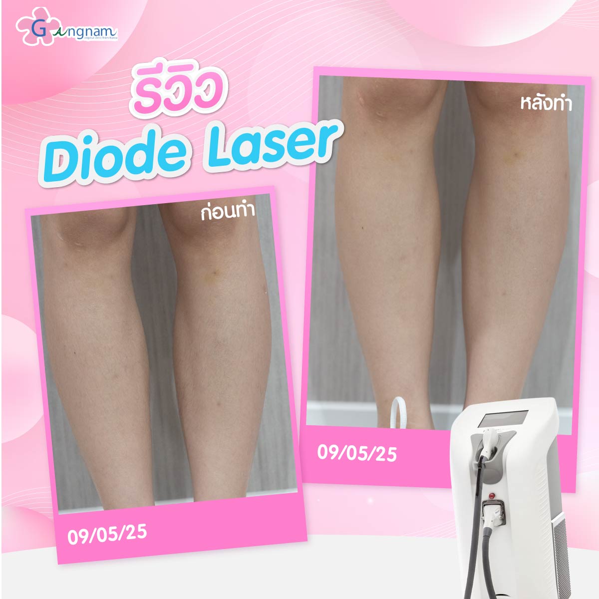 รู้จัก! Diode Laser คืออะไร วิธีทำงาน ข้อดี - ข้อเสีย และเหมาะกับใคร ...