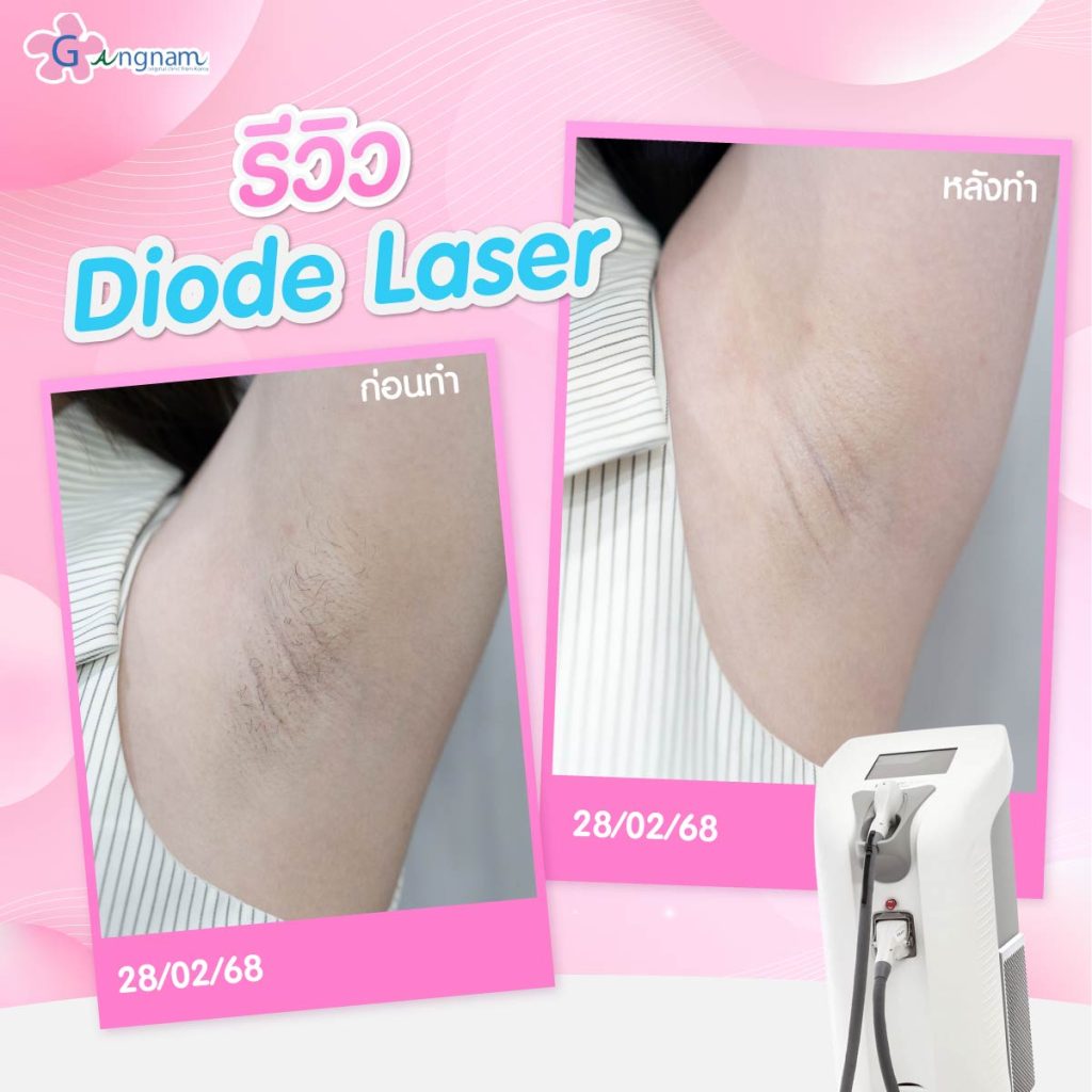 รู้จัก! Diode Laser คืออะไร วิธีทำงาน ข้อดี - ข้อเสีย และเหมาะกับใครที่สุด - กังนัมคลินิก ...