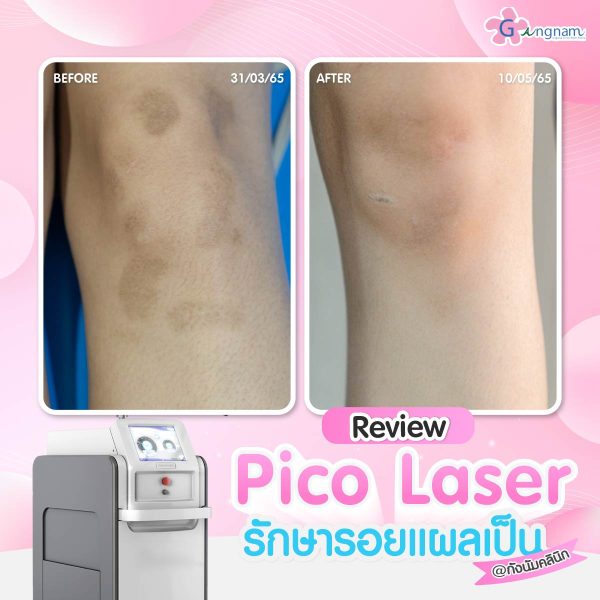 Pico Laser คืออะไร? รวมข้อมูลครบ ข้อดี ข้อเสีย และการดูแลหลังทำ - กัง ...