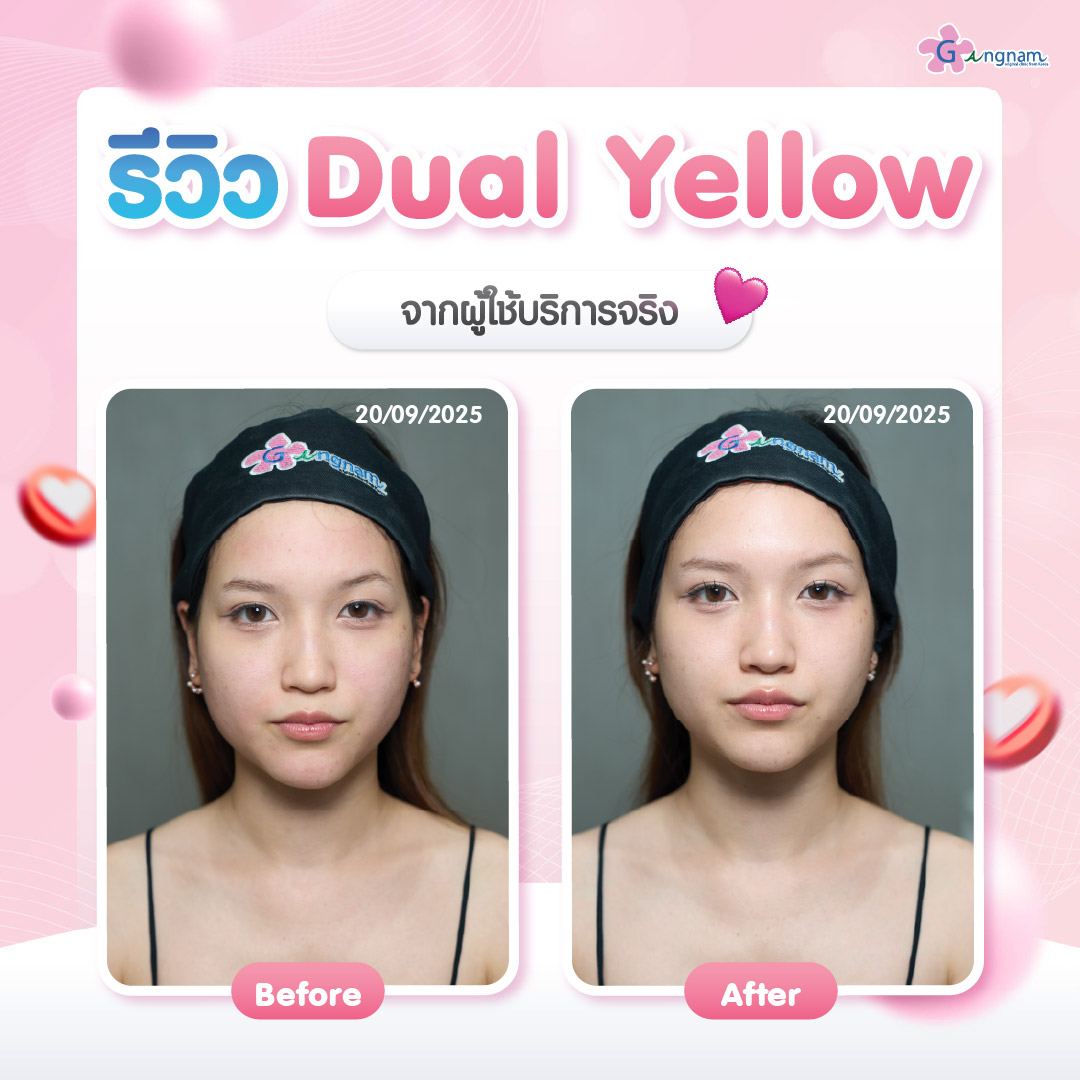 Dual Yellow Laser คืออะไร เหมาะกับปัญหาผิวแบบไหน ช่วยอะไรบ้าง มีผลข้าง ...